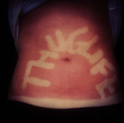 20 Hilarious Sunburns to Make You Feel the Burn - Epic Fails